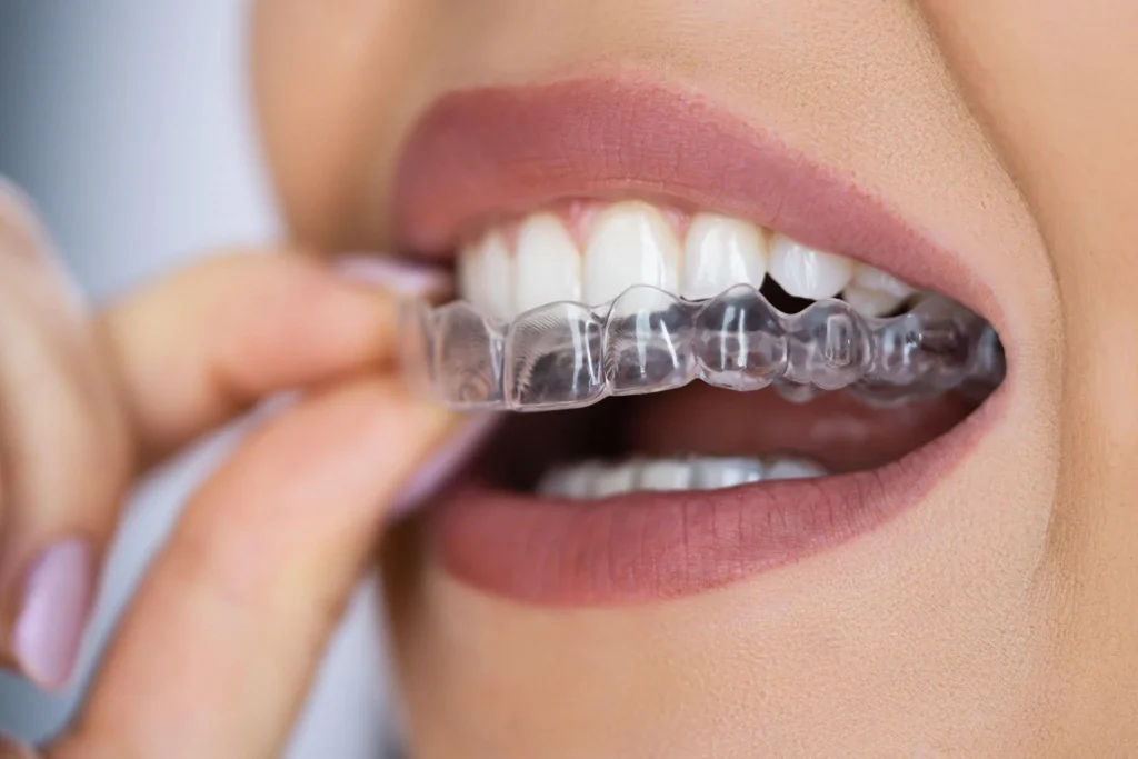 Why Invisalign? - Queens Plate Dental